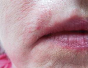 Lime Light/ IPL | The Dermatology Clinic
