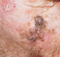 skincancer-10 | The Dermatology Clinic